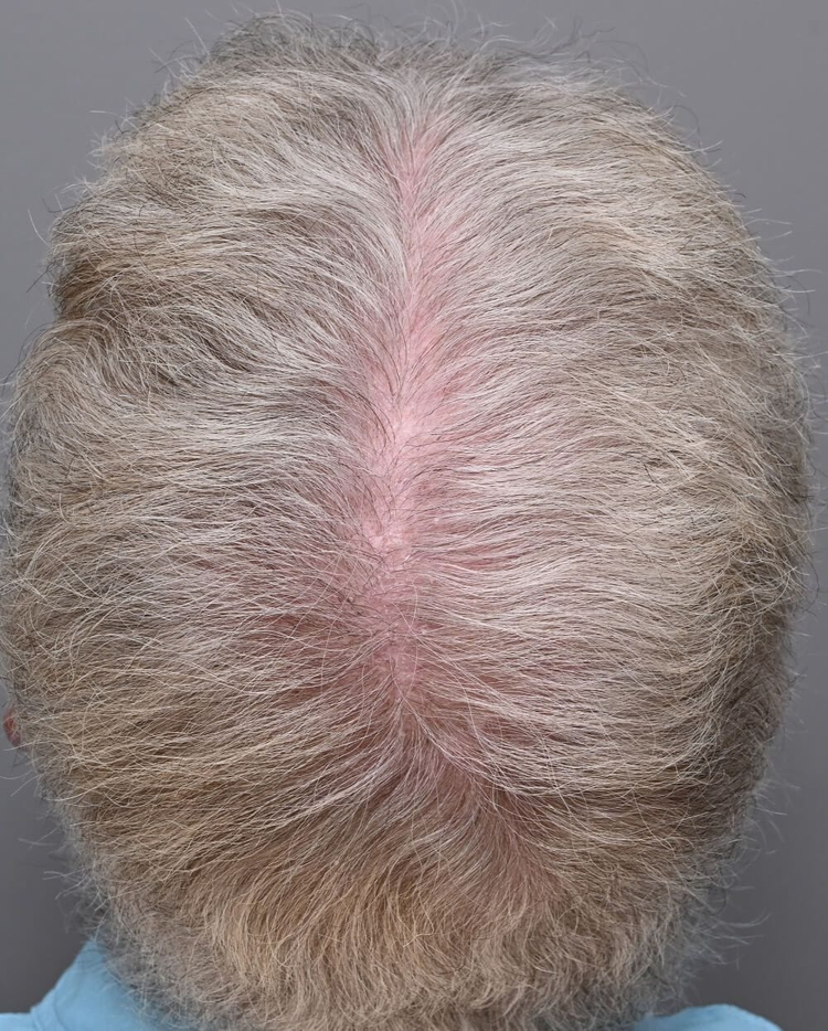 Folitin Hair Growth Serum For Hair Regrowth & Scalp Health