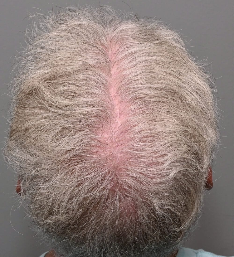 Folitin Hair Growth Serum For Hair Regrowth & Scalp Health